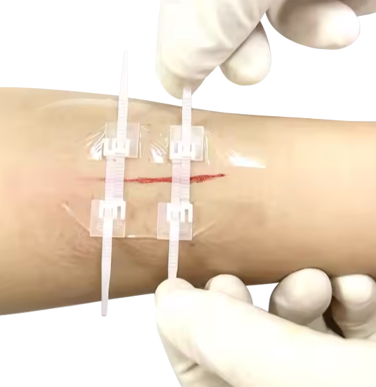 BOENMED® Wound Closure Device
