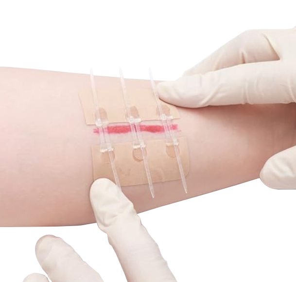 BOENMED® Zipper Wound Closure Patches