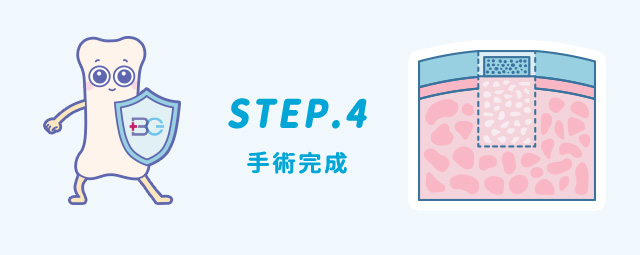 BioGend Therapeutics | 兩相軟骨修復骨材技術